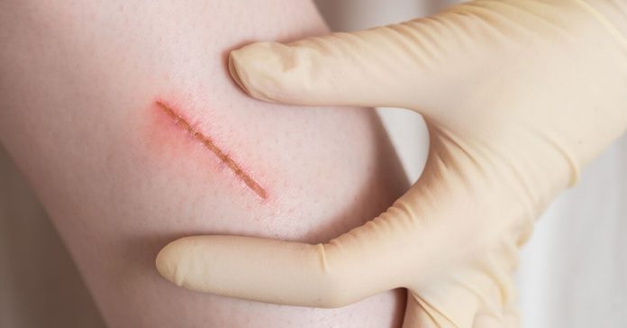 Ce spray innovant tisse un bandage directement sur les plaies