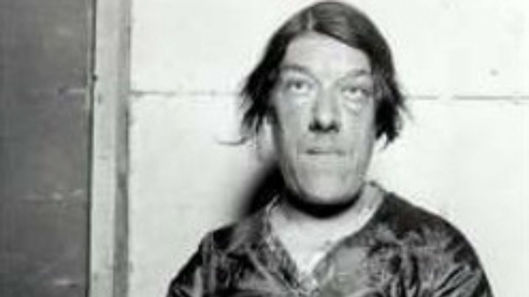La vie tragique de Mary Ann Bevan, cette femme exhibée comme une bête ...