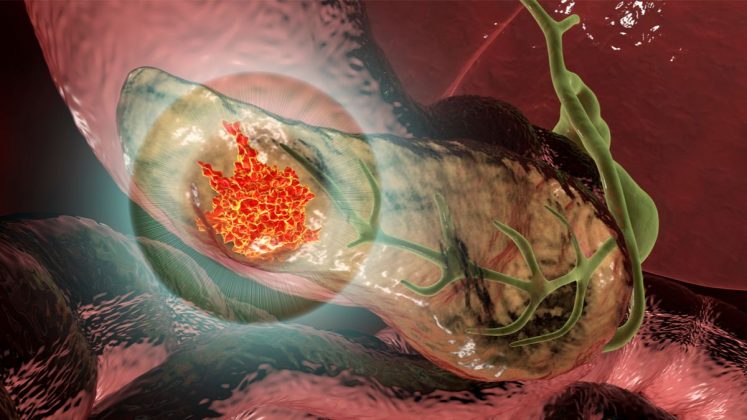 Cancer : un implant radioactif élimine les tumeurs dans un succès ...