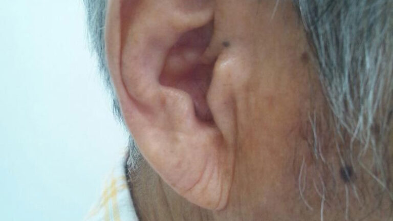 Ce pli cutané sur votre lobe d’oreille peut en dire long sur votre état ...